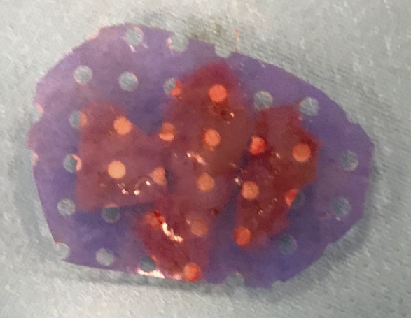 How I batted away my anxiety to face up to a nose op | Islington Tribune